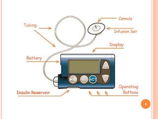 Insulin pump | PPT