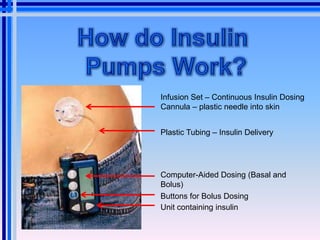 Insulin pump presentation | PPTX