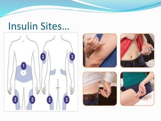 Insulin technique: simpler | PPSX