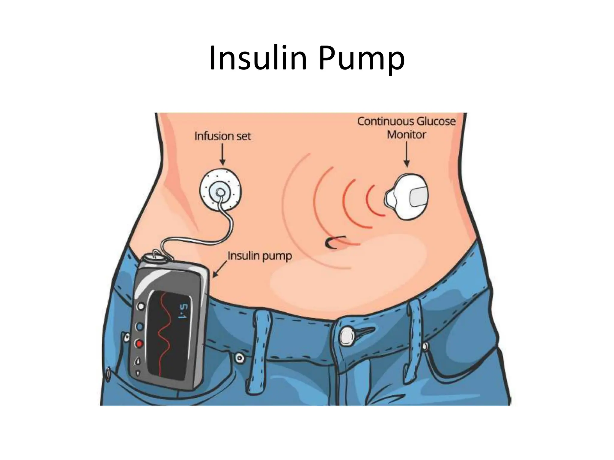 INSULI THERAPY.pptx. All about Insulin, Mode of ation, doses. | PPTX