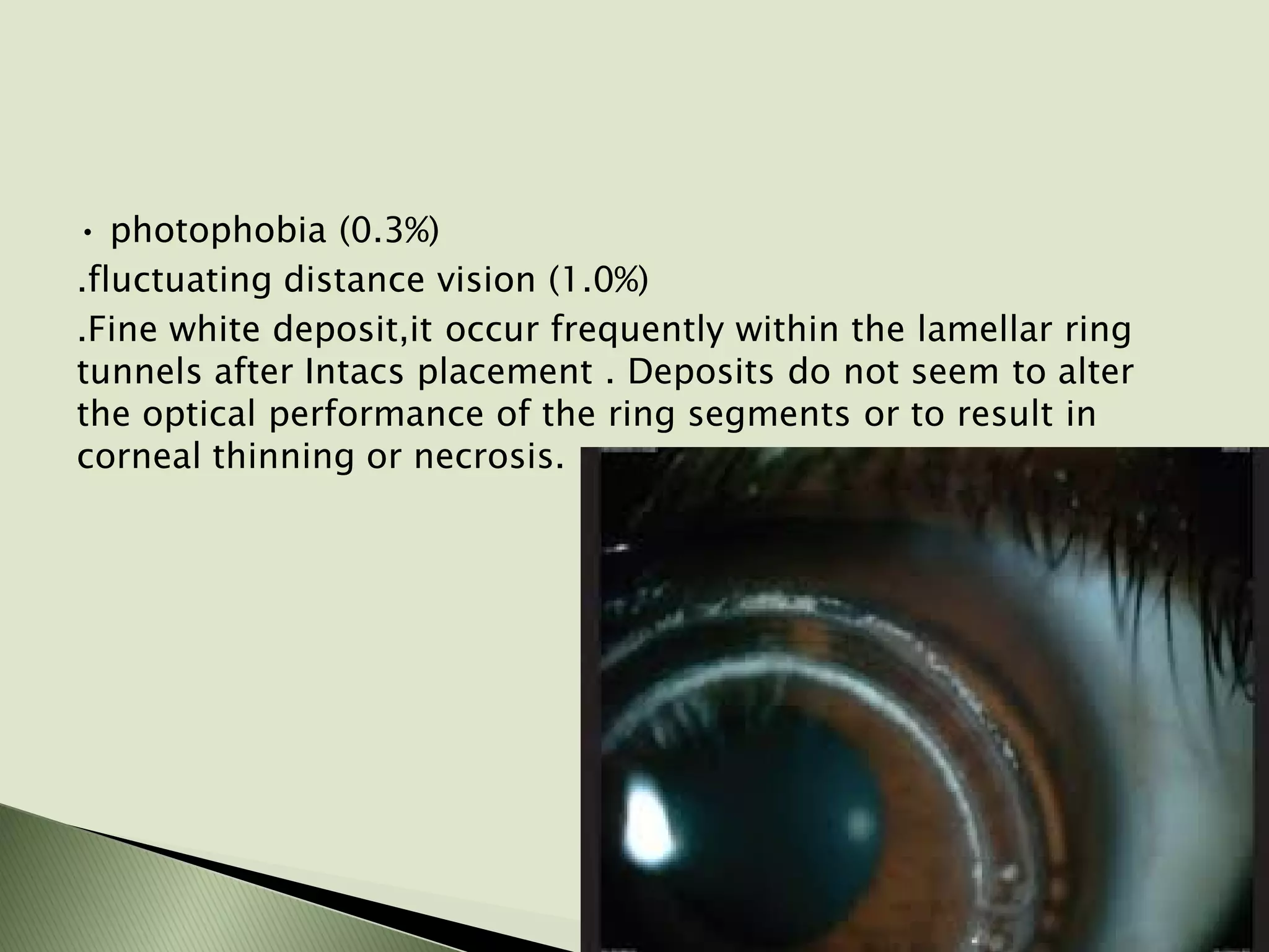 Intrastromal Corneal Ring Segment (ICRSs) | PDF