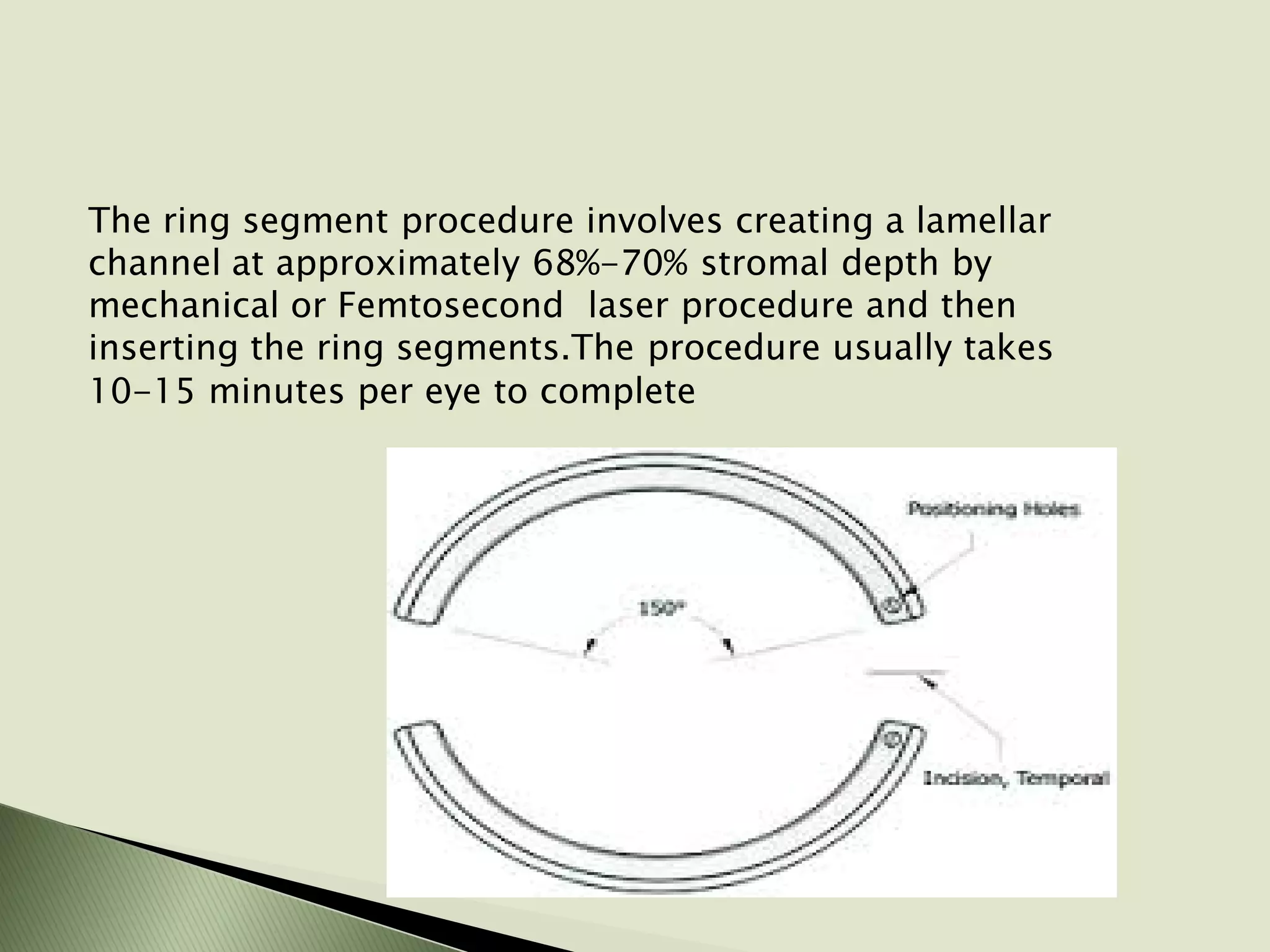 Intrastromal Corneal Ring Segment (ICRSs) | PDF