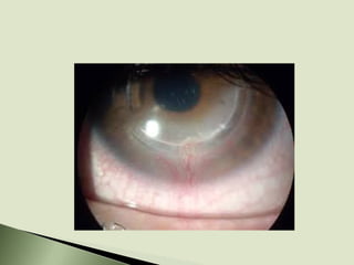 Intrastromal Corneal Ring Segment (ICRSs) | PDF
