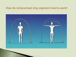 Intrastromal Corneal Ring Segment (ICRSs) | PDF