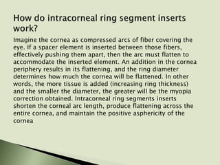 Intrastromal Corneal Ring Segment (ICRSs) | PDF