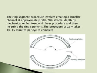 Intrastromal Corneal Ring Segment (ICRSs) | PPT