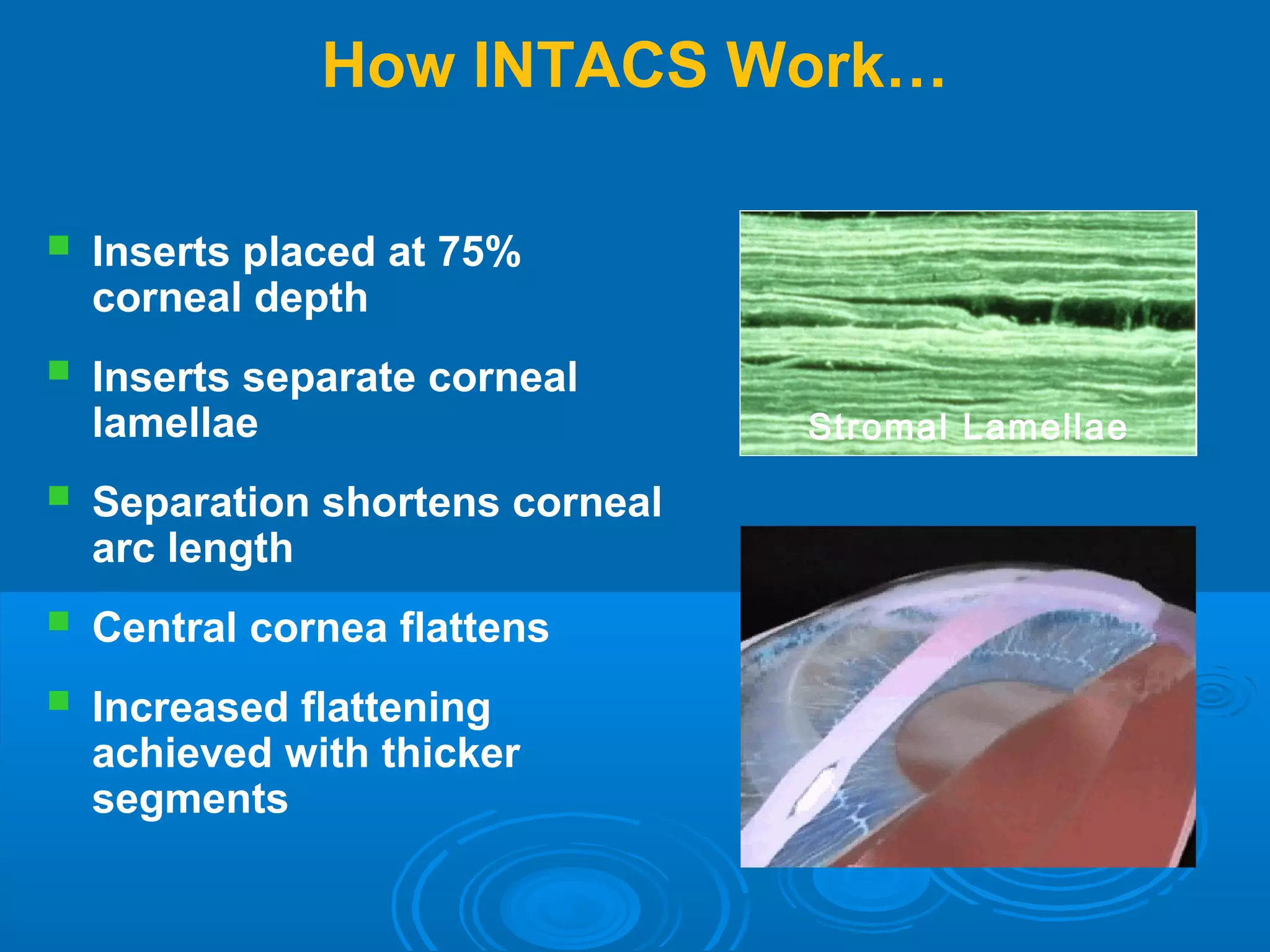 Intacs, Corneal inserts for treatment of keratoconus and ectasia | PPT