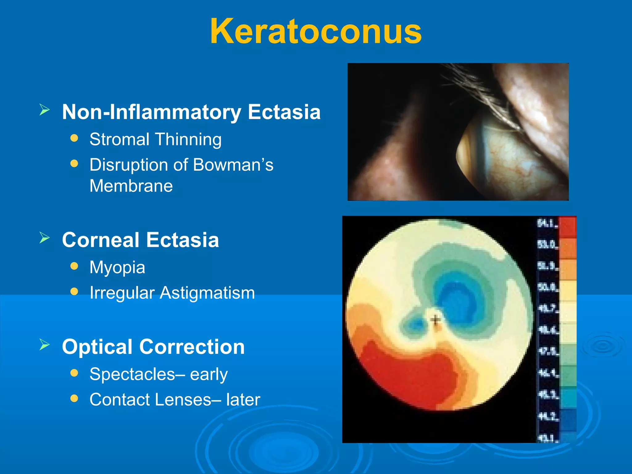 Intacs, Corneal inserts for treatment of keratoconus and ectasia | PPT