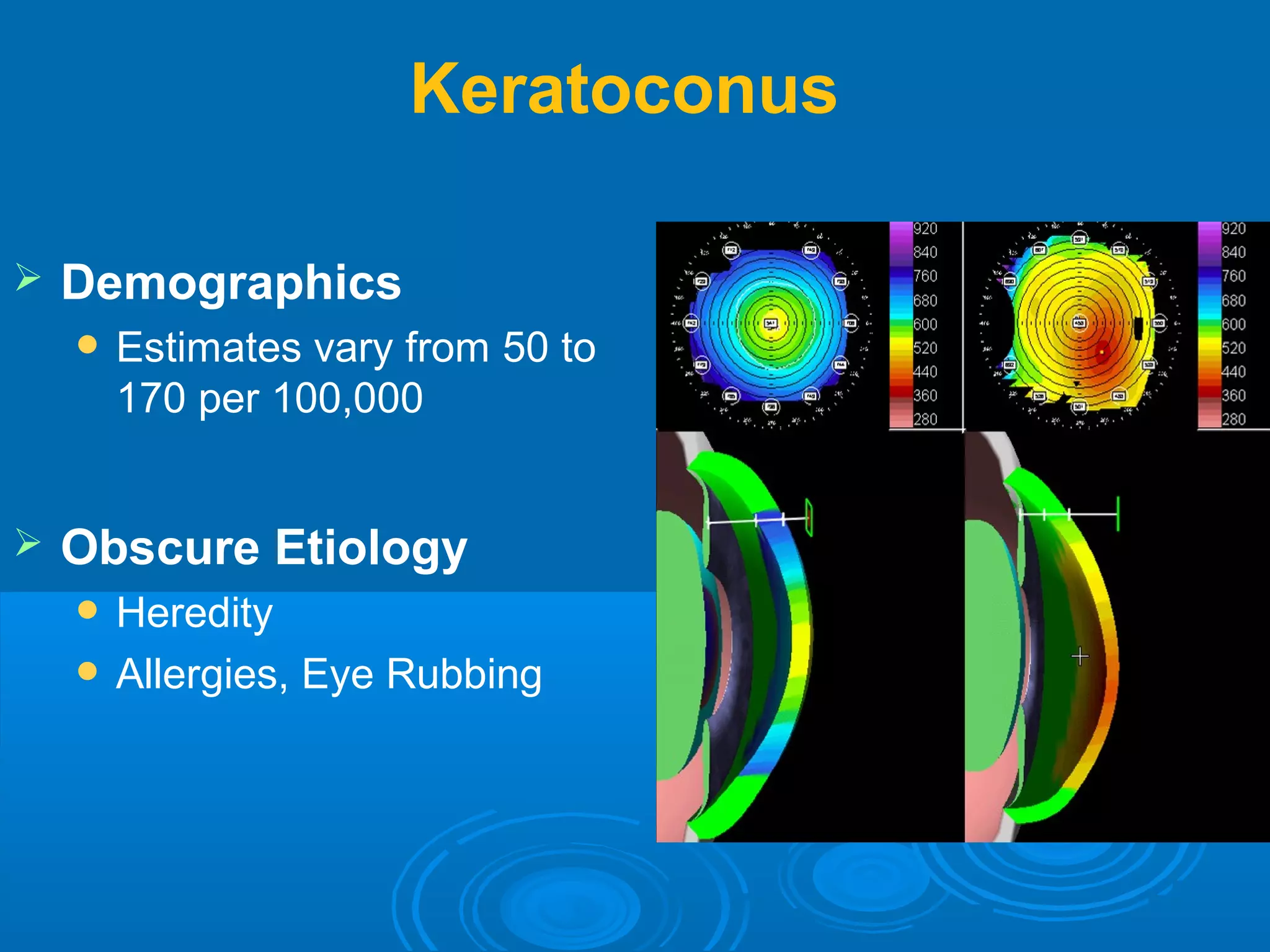 Intacs, Corneal inserts for treatment of keratoconus and ectasia | PPT