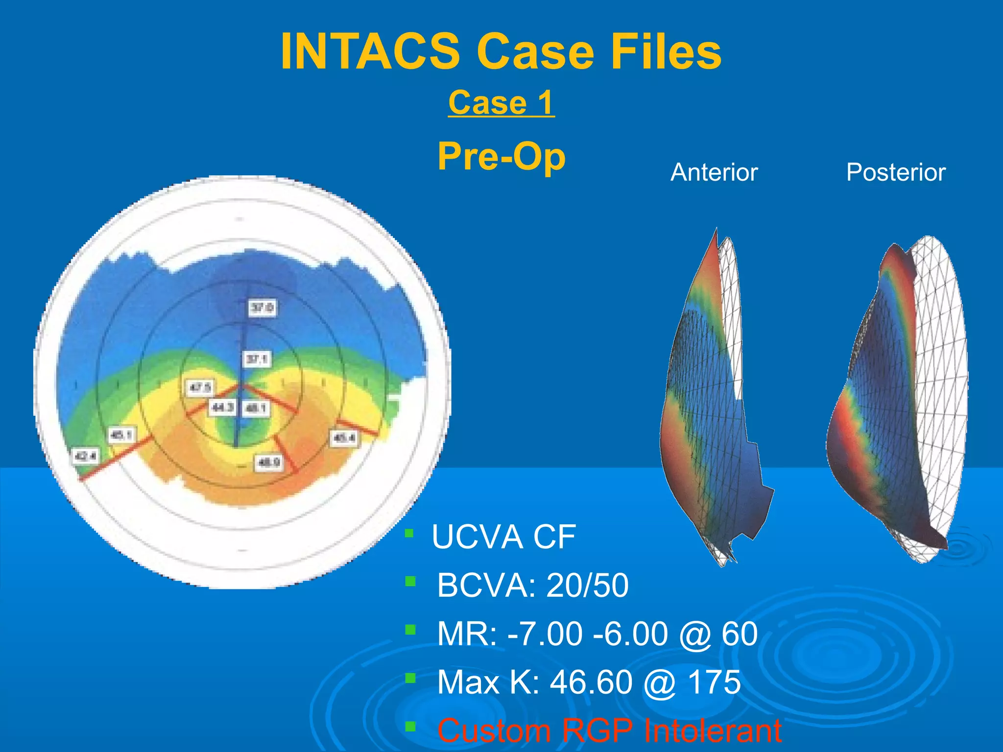 Intacs, Corneal inserts for treatment of keratoconus and ectasia | PPT