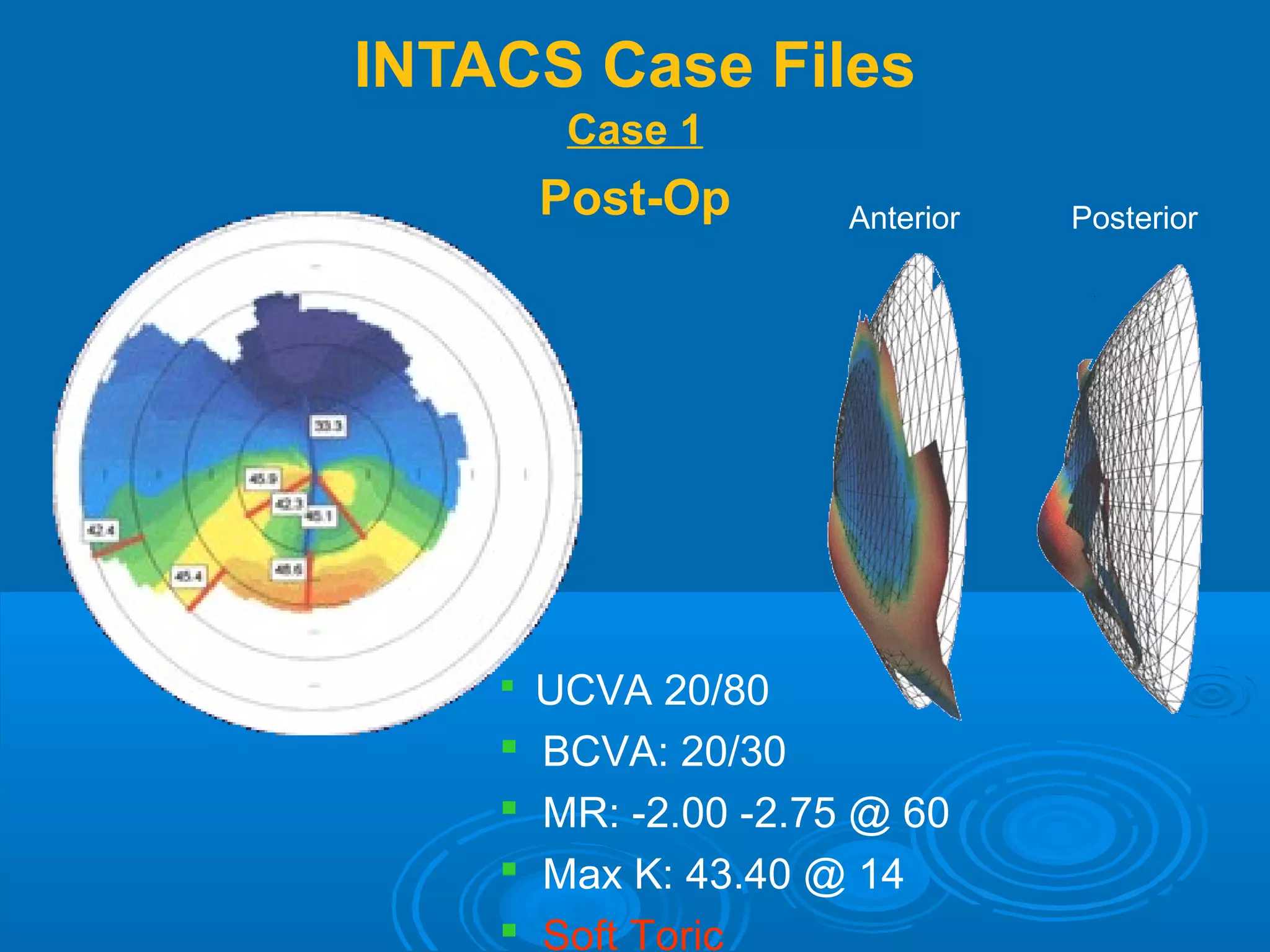 Intacs, Corneal inserts for treatment of keratoconus and ectasia | PPT
