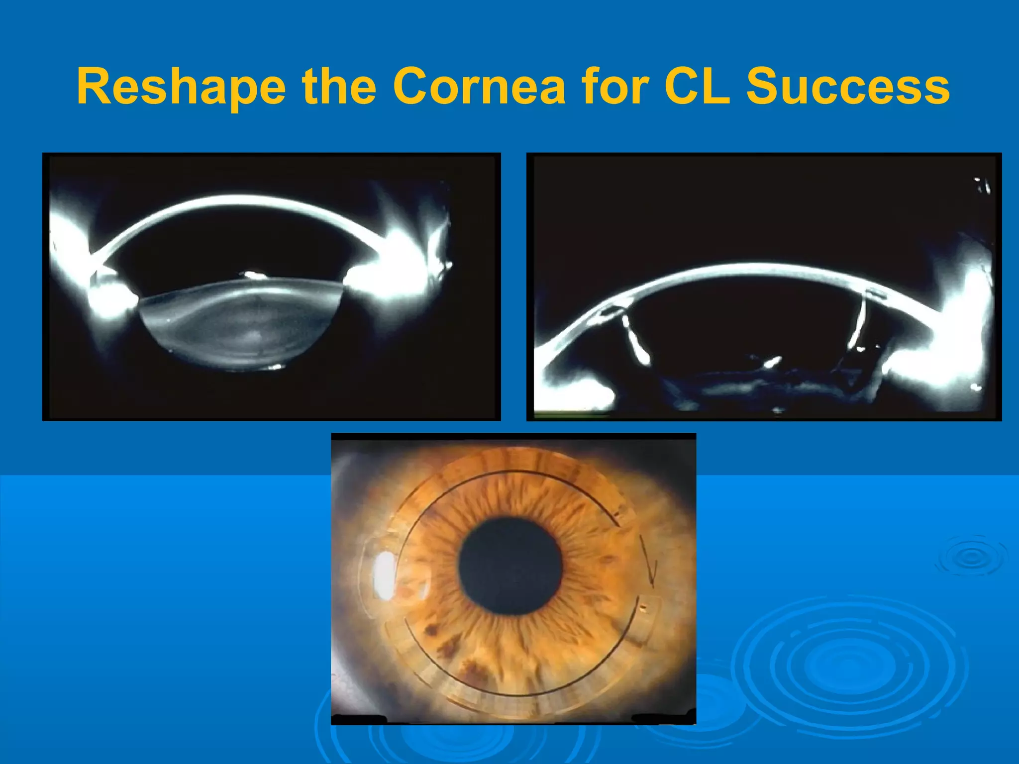 Intacs, Corneal inserts for treatment of keratoconus and ectasia | PPT