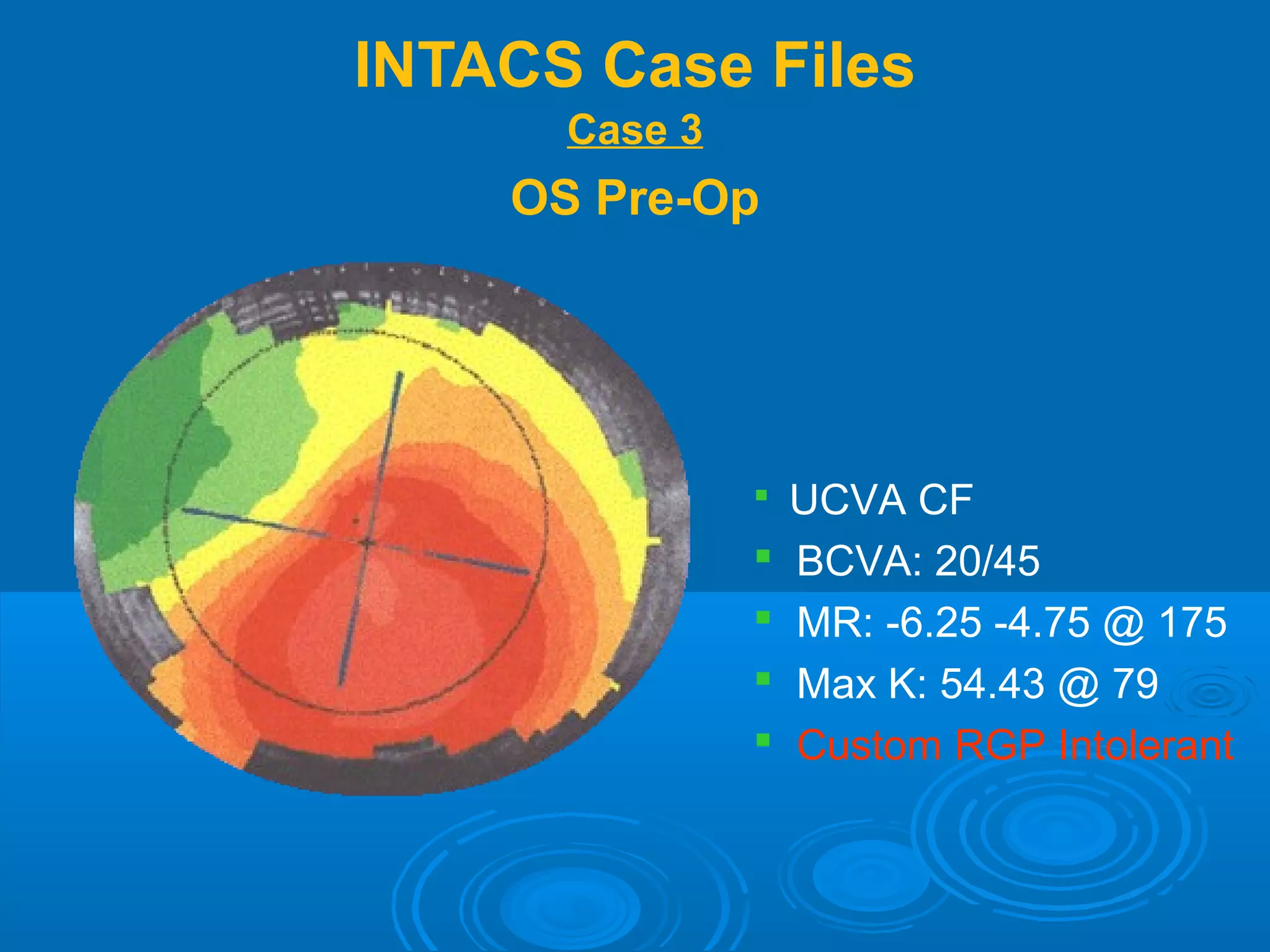 Intacs, Corneal inserts for treatment of keratoconus and ectasia | PPT