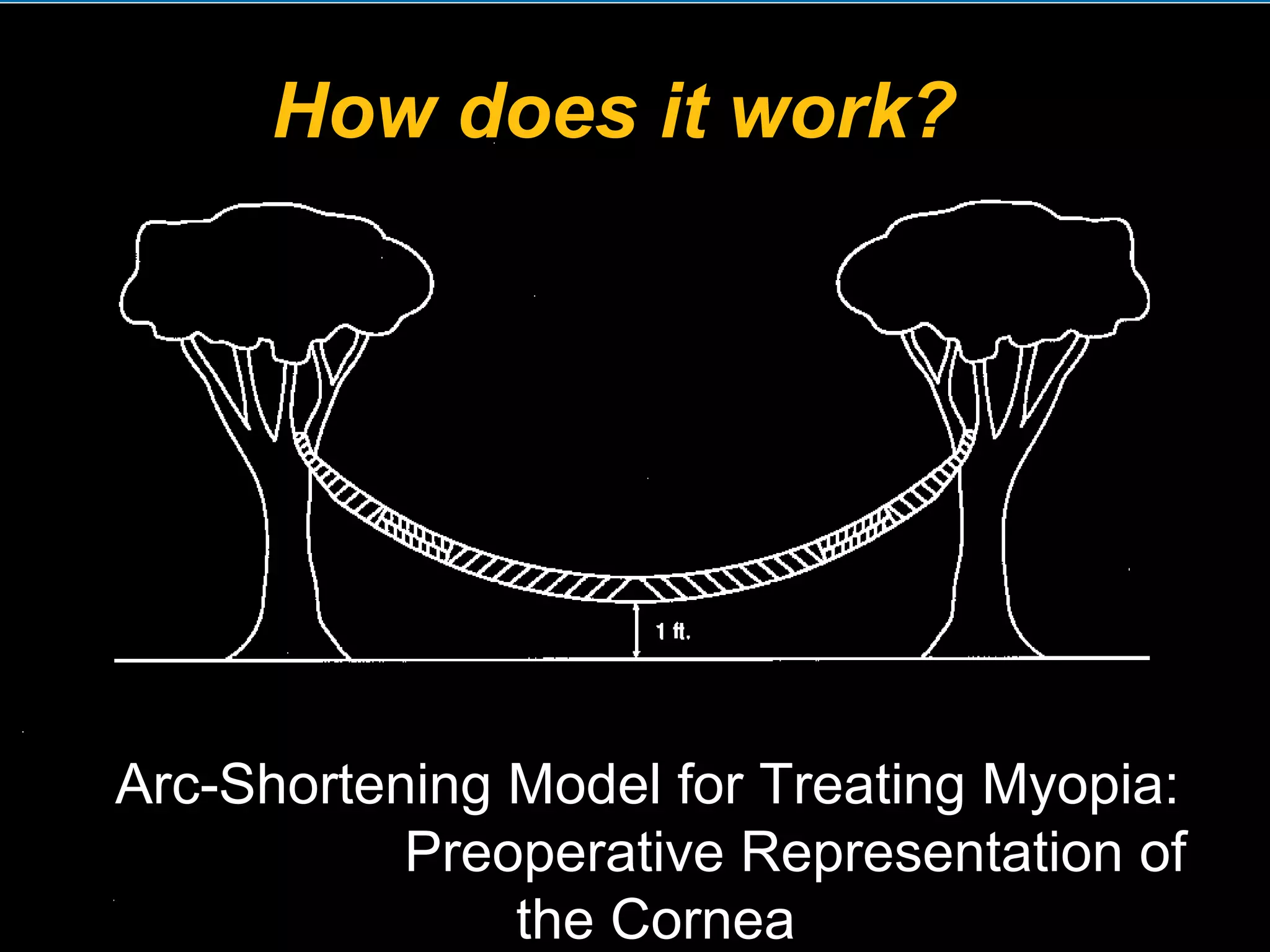 Intacs, Corneal inserts for treatment of keratoconus and ectasia | PPT