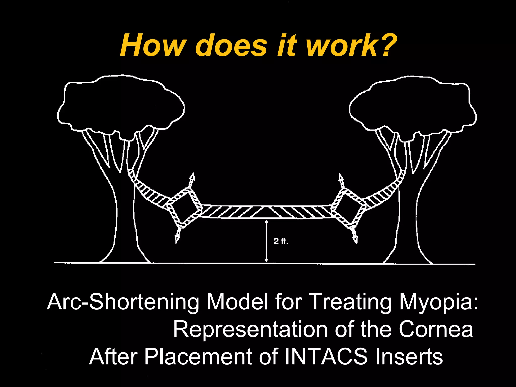 Intacs, Corneal inserts for treatment of keratoconus and ectasia | PPT