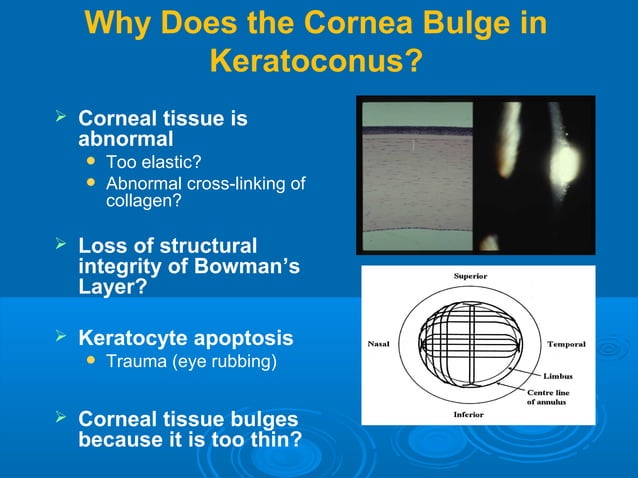 Intacs, Corneal inserts for treatment of keratoconus and ectasia | PPT ...