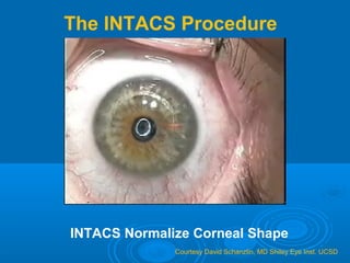 Intacs, Corneal inserts for treatment of keratoconus and ectasia | PPT