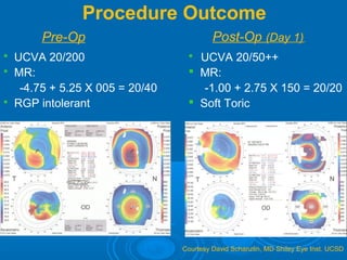 Intacs, Corneal inserts for treatment of keratoconus and ectasia | PPT