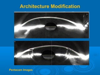 Intacs, Corneal inserts for treatment of keratoconus and ectasia | PPT