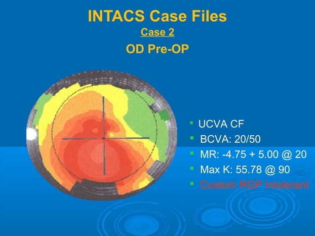 Intacs, Corneal inserts for treatment of keratoconus and ectasia | PPT ...