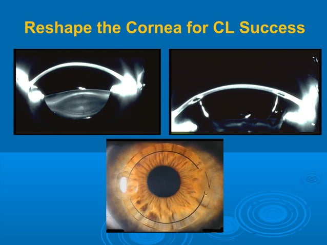 Intacs, Corneal inserts for treatment of keratoconus and ectasia | PPT ...