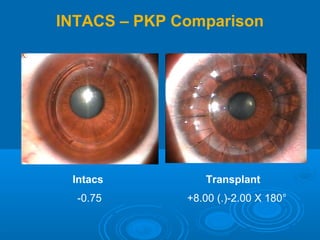 Intacs, Corneal inserts for treatment of keratoconus and ectasia | PPT