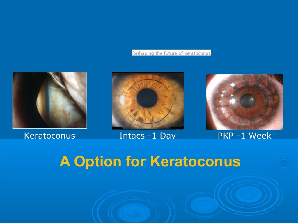 Intacs, Corneal inserts for treatment of keratoconus and ectasia