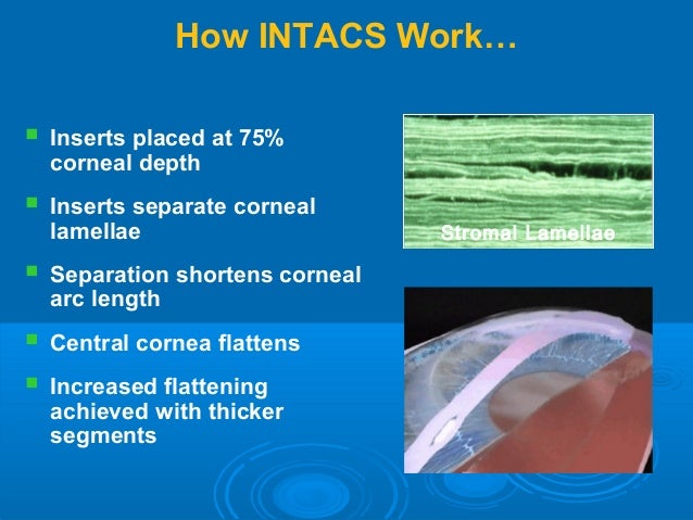 Intacs, Corneal inserts for treatment of keratoconus and ectasia
