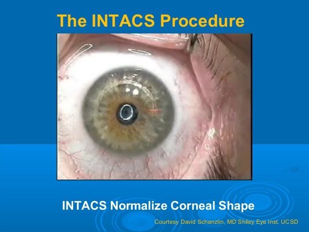 Intacs, Corneal inserts for treatment of keratoconus and ectasia