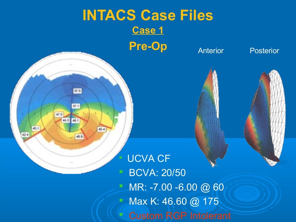 Intacs, Corneal inserts for treatment of keratoconus and ectasia