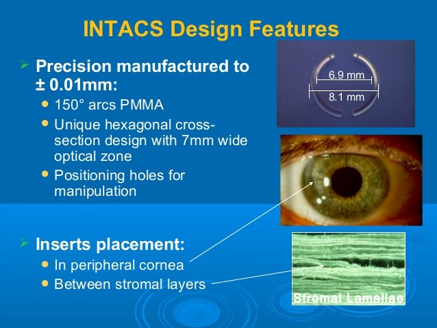 Intacs, Corneal inserts for treatment of keratoconus and ectasia
