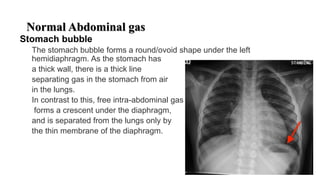 inteestinal gas.pptx