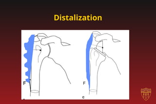 Integra_-_Reverse_Total_Shoulder_Arthroplasty.ppt