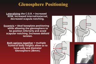 Integra_-_Reverse_Total_Shoulder_Arthroplasty.ppt