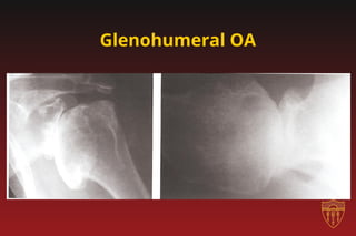 Integra_-_Reverse_Total_Shoulder_Arthroplasty.ppt