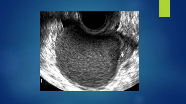 Integrated approach to infertility work up | PPTX