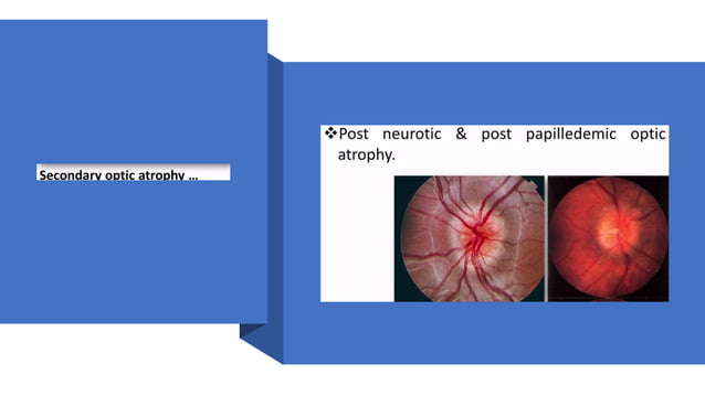 integrated optic nerve.pptx