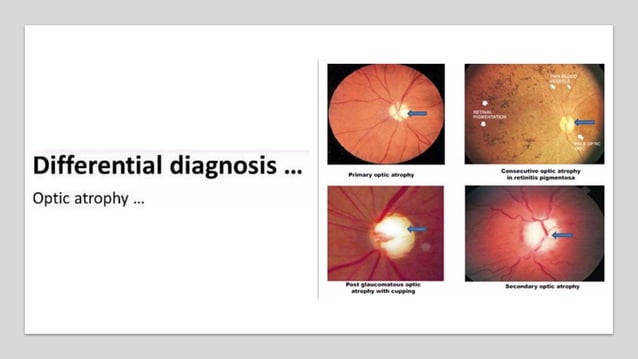 integrated optic nerve.pptx
