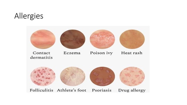Integumentary disorder / skin disease , its clinical manifestation and ...