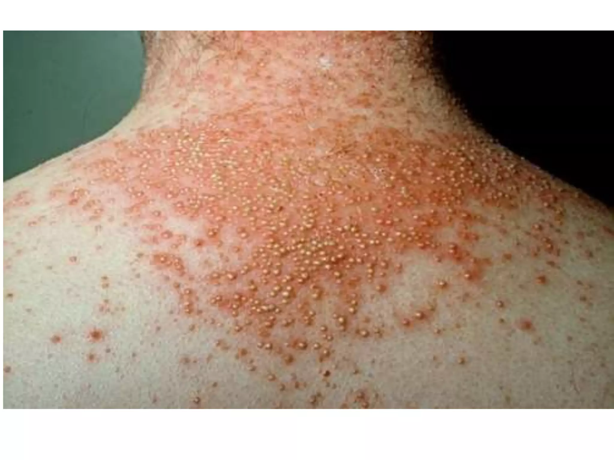 Integumentary disorders 2 | PPTX