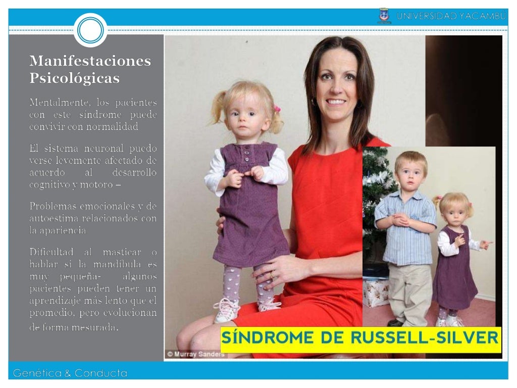 Sindrome Russell Silver; Síndrome Cri du chat