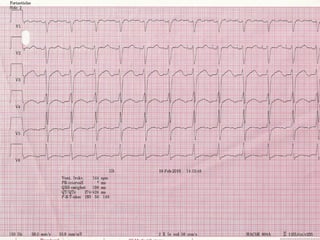 Intensivkurs i EKG-tolkning, av Erik Gjertsen | PDF