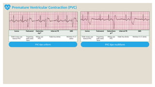 Intepreatasi Gambaran EKG pada Aritmia dan Penatalaksanaan Awal.pptx