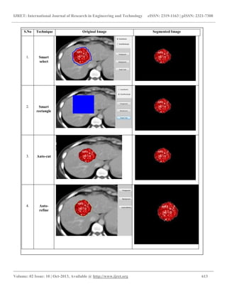 Interactive liver tumor segmentation using | PDF