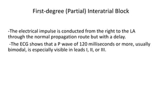 Interatrial Block (IAB) | PPT