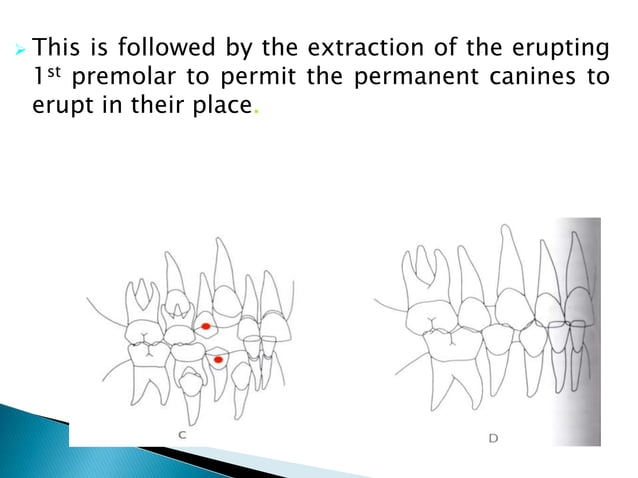 interceptive final.pptx