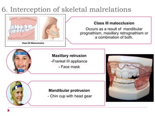Interceptive orthodontics | PPTX