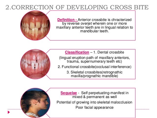 Interceptive orthodontics