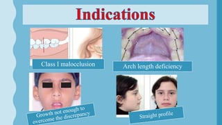 Interceptive orthodontics | PPTX