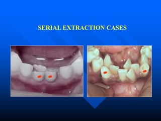 Interceptive Orthodontics | PPT